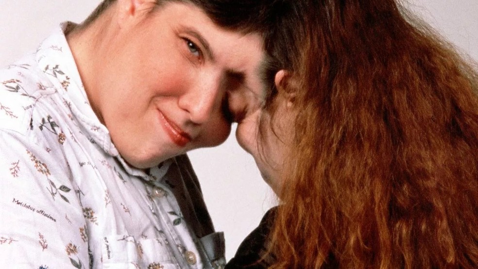 Siameses mais velhos do mundo apoiavam vida amorosa um do outro; um ...