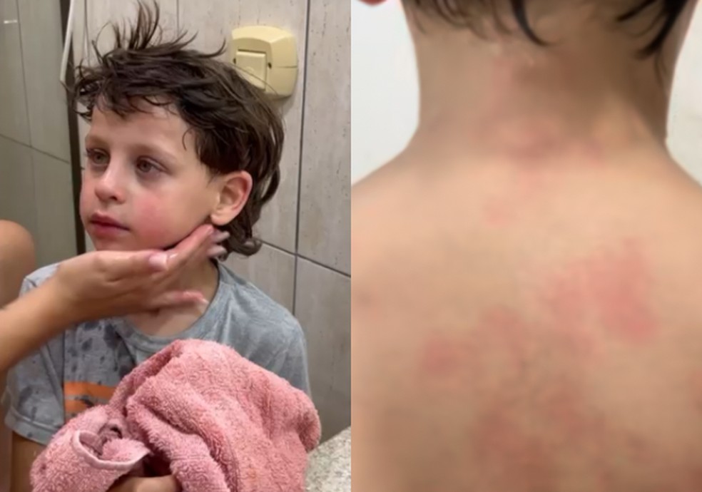 Menino de 7 anos tem alergia ao suor e ao calor: 'O desafio é manter ...