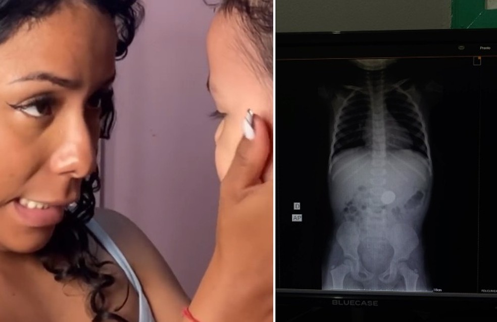 Mãe fica sem reação após filha revelar o que engoliu e raio X confirma