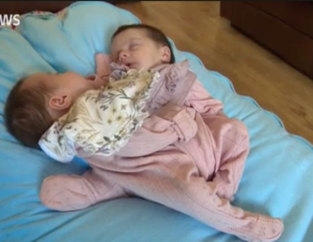 8 histórias impressionantes de gêmeos siameses