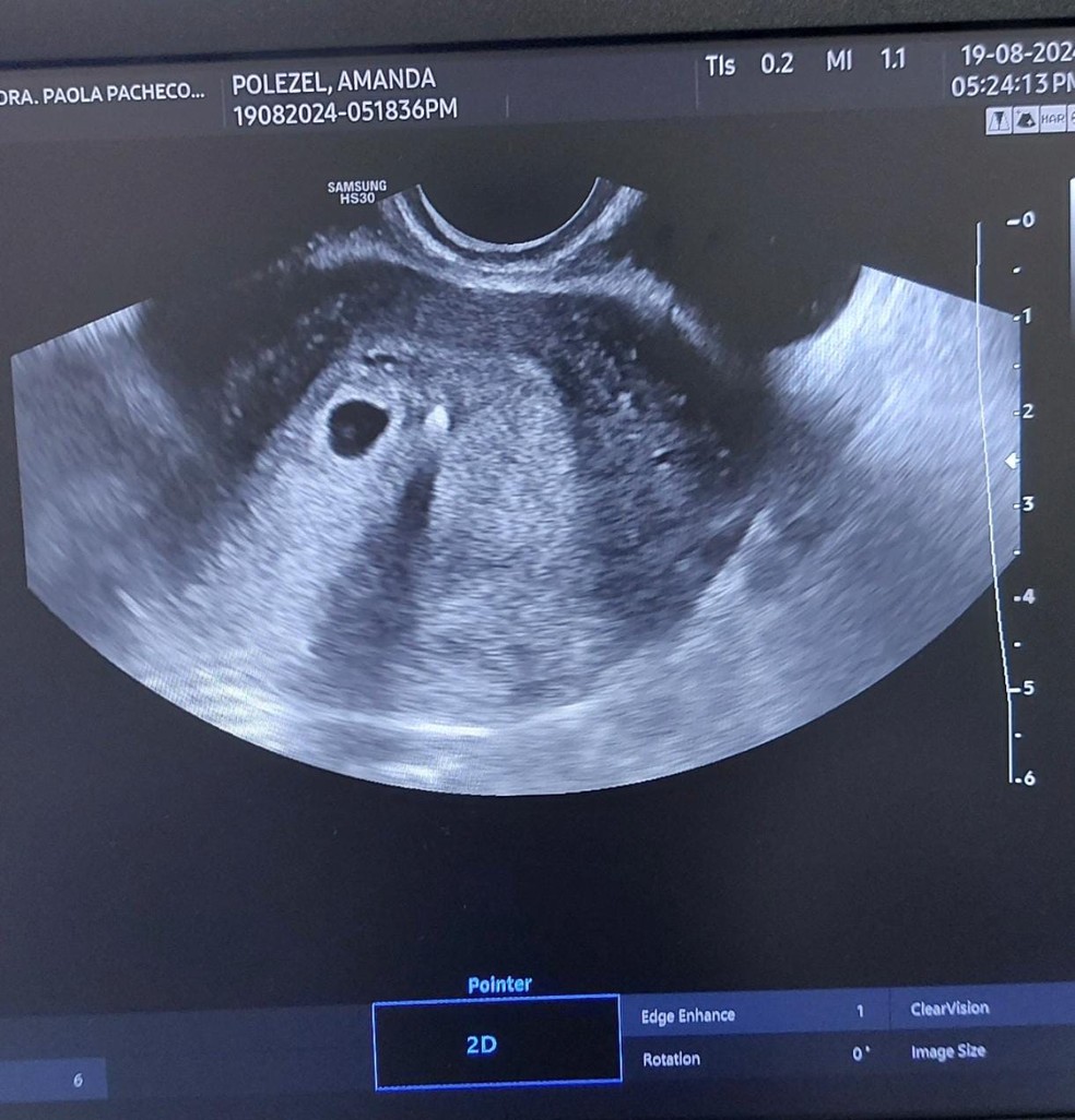 Raríssimo: bebê nasce com DIU, em SP, e mãe faz registro impactante