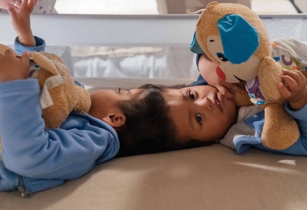 8 histórias impressionantes de gêmeos siameses