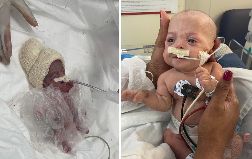 Prematuro extremo nasce com apenas 440 gramas e completa cinco meses na UTI, em SP