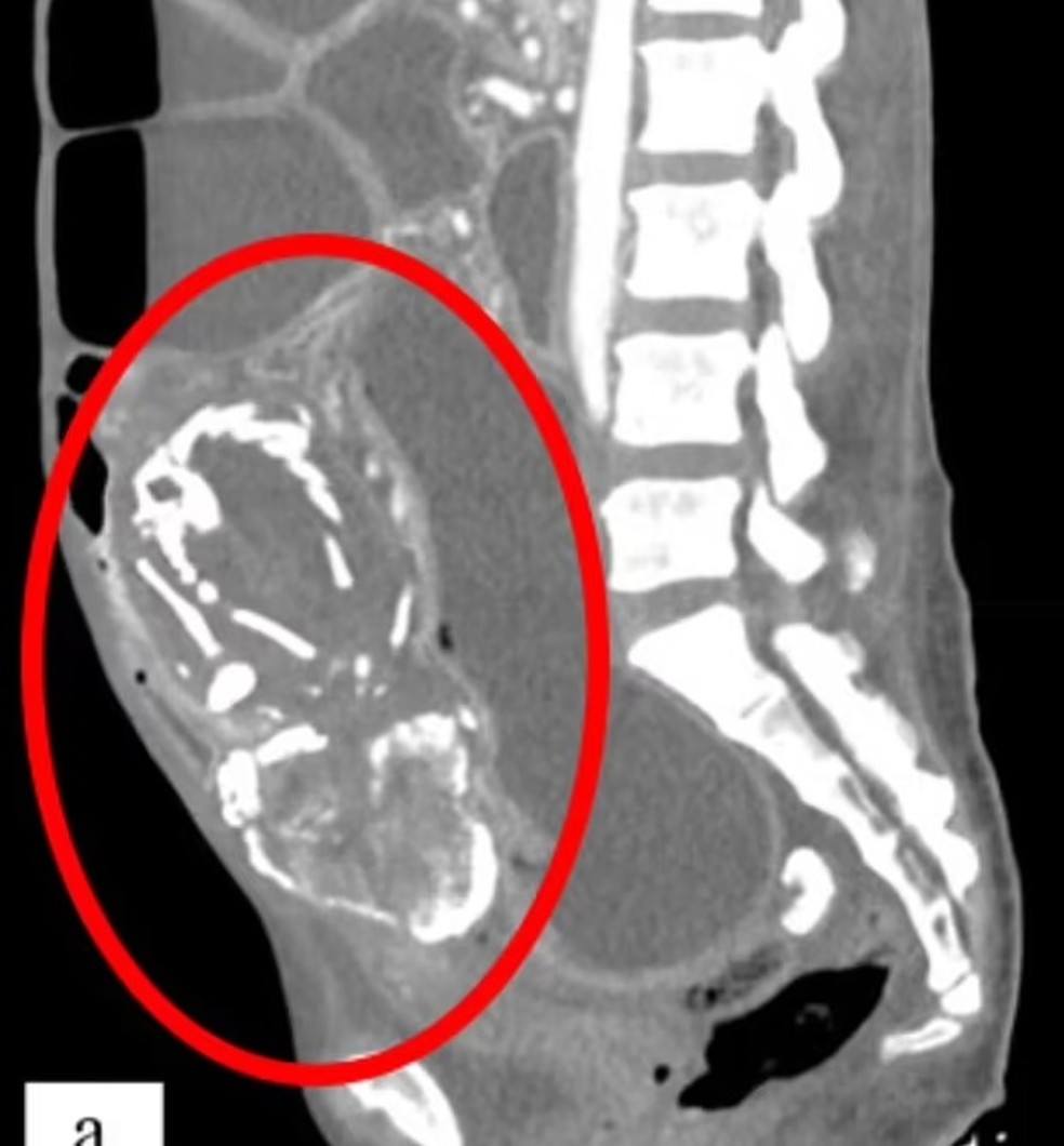 Mulher que ficou com feto alojado na barriga por nove anos morre de ...