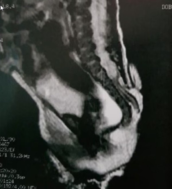 Caso de bebê brasileira que nasceu com cauda é publicado em revista médica