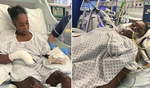 Após dar à luz gêmeos, mãe enfrenta amputação do braço, pernas e mão