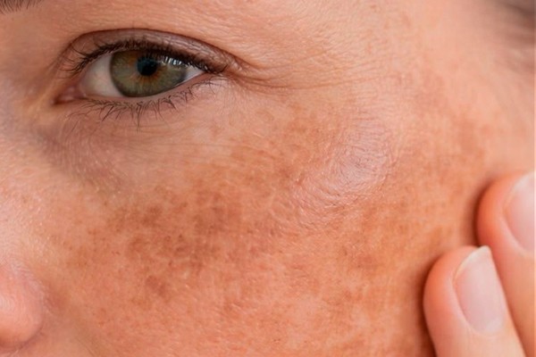 Manchas na gravidez: o que é melasma, como prevenir e quando tratar
