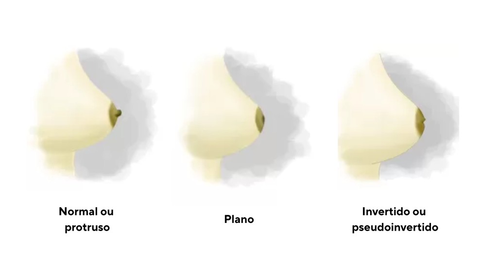 Amamentação com bico invertido: é possível? Saiba o que fazer e como ...