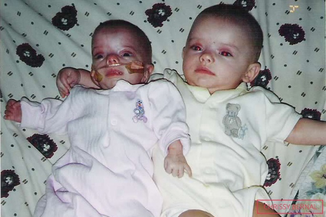 Conheça a história das gêmeas idênticas, mas 'diferentes' — uma delas ...