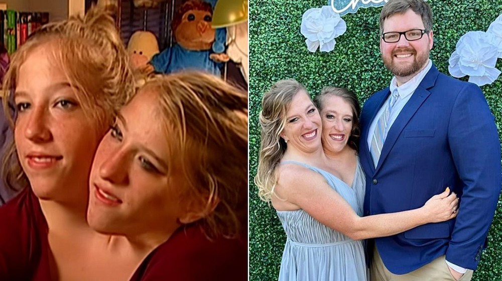 Gêmeas siamesas recebem elogios por foto de biquíni