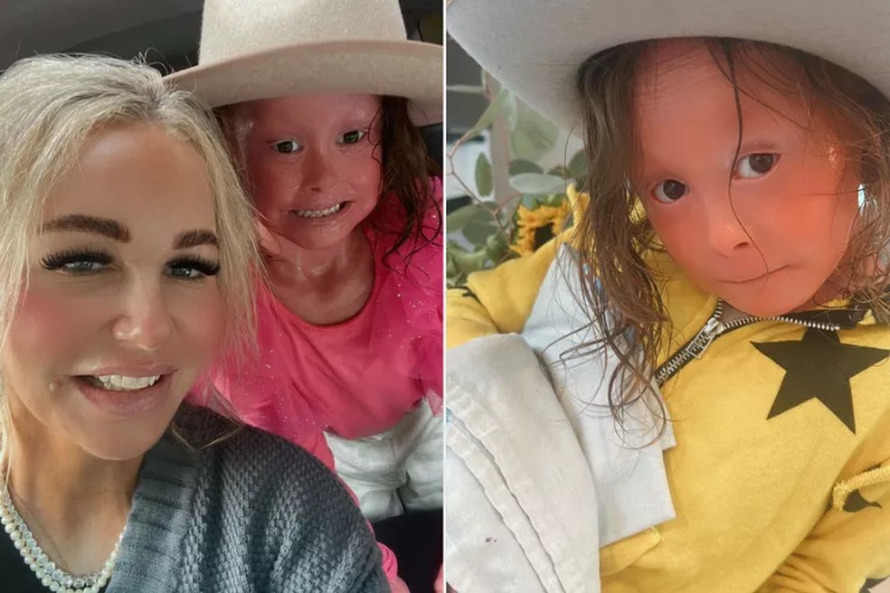 Menina tem condição rara que deixa pele como uma 'ferida aberta ...