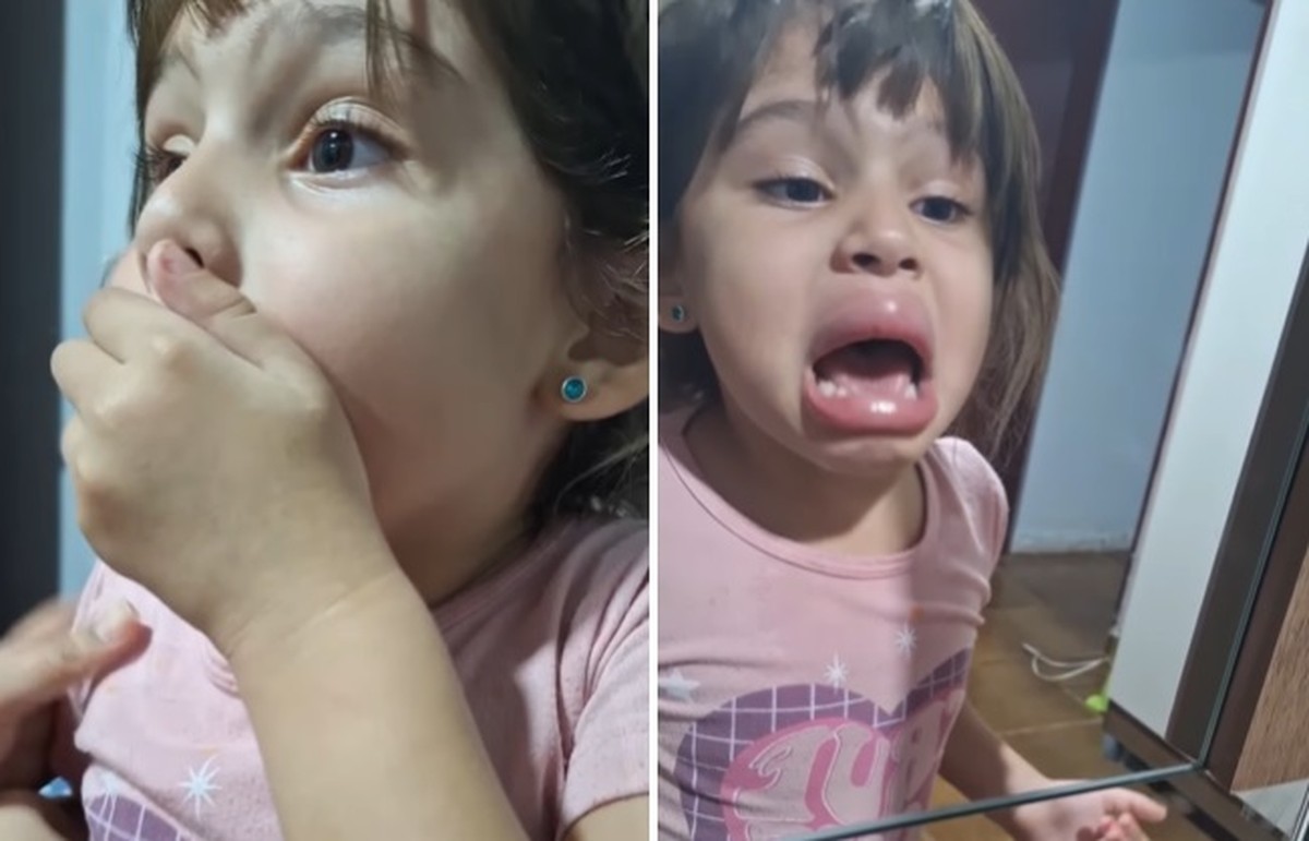 Menina de 5 anos assusta ao inchar lábios com desodorante: 'Minha boca ...