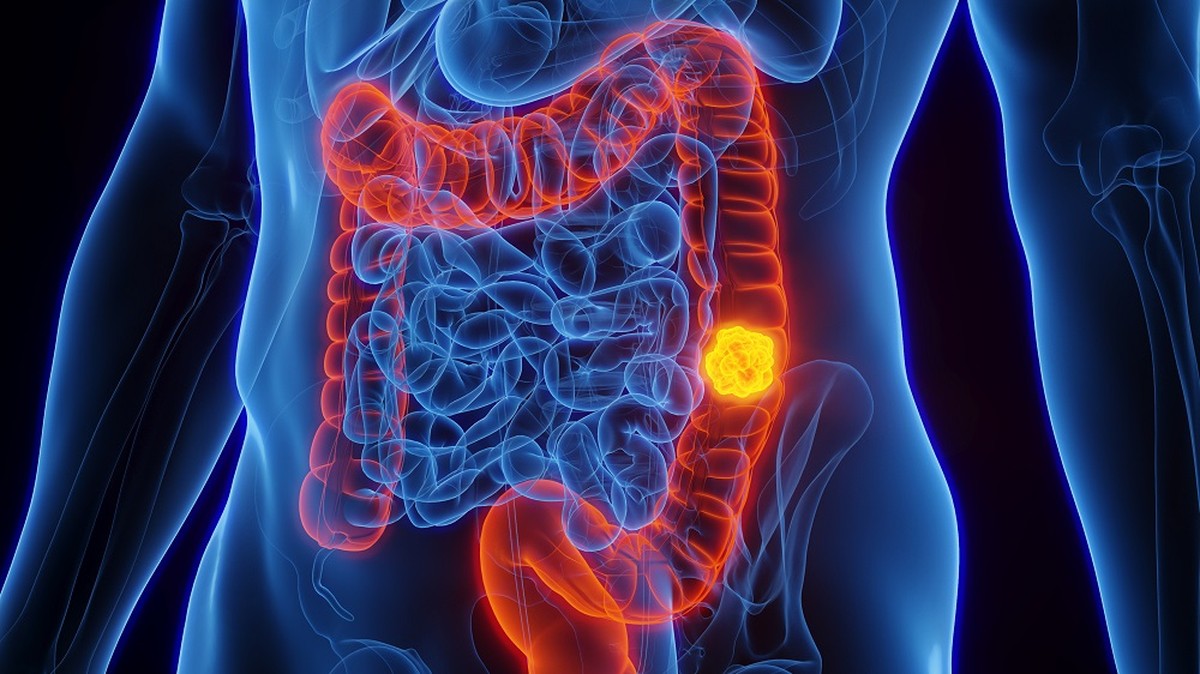Câncer intestinal, como o de Preta Gil, pode ter ligação com bactéria ...