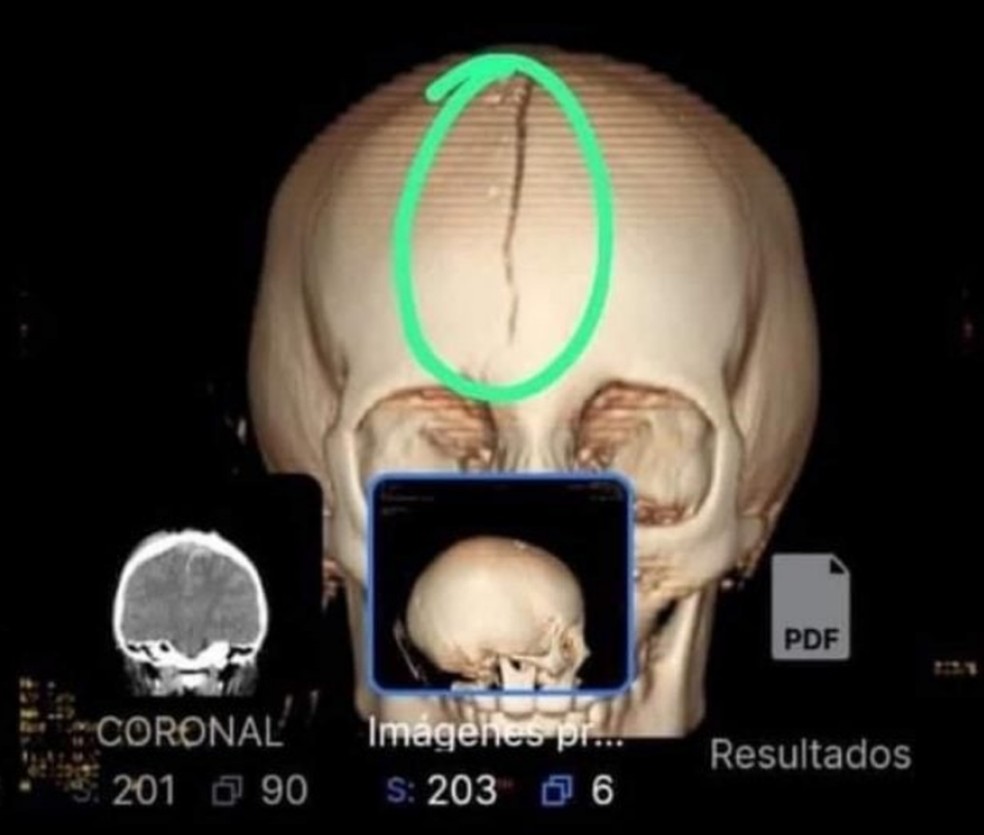 Imagens De Raio X De Fratura De Cranio Dr Diego Munhoz Especialista Em