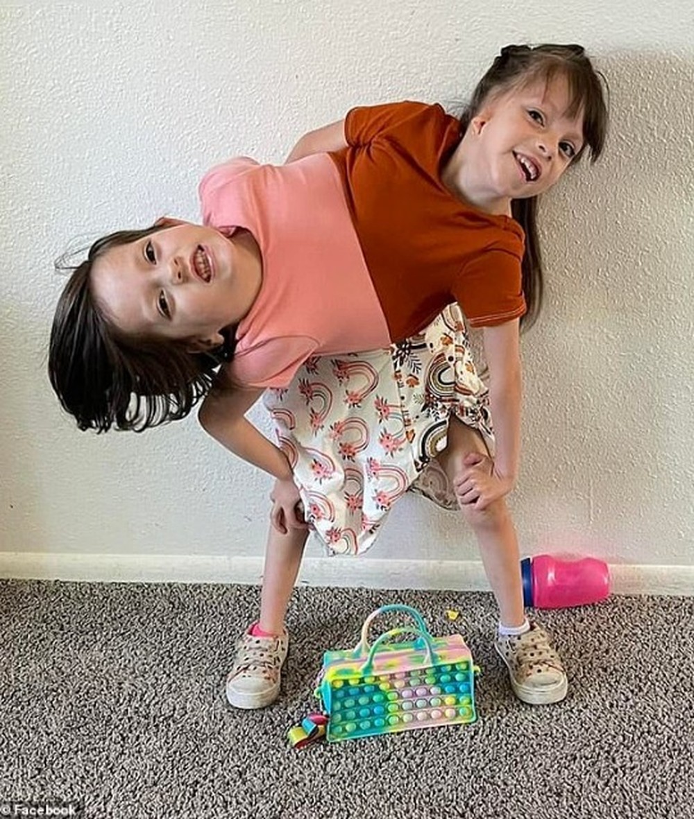 8 histórias impressionantes de gêmeos siameses