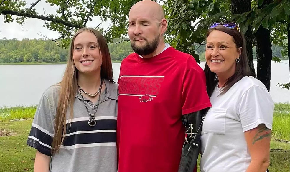 Pai que recebeu transplante inédito de rosto e olhos revela novas fotos