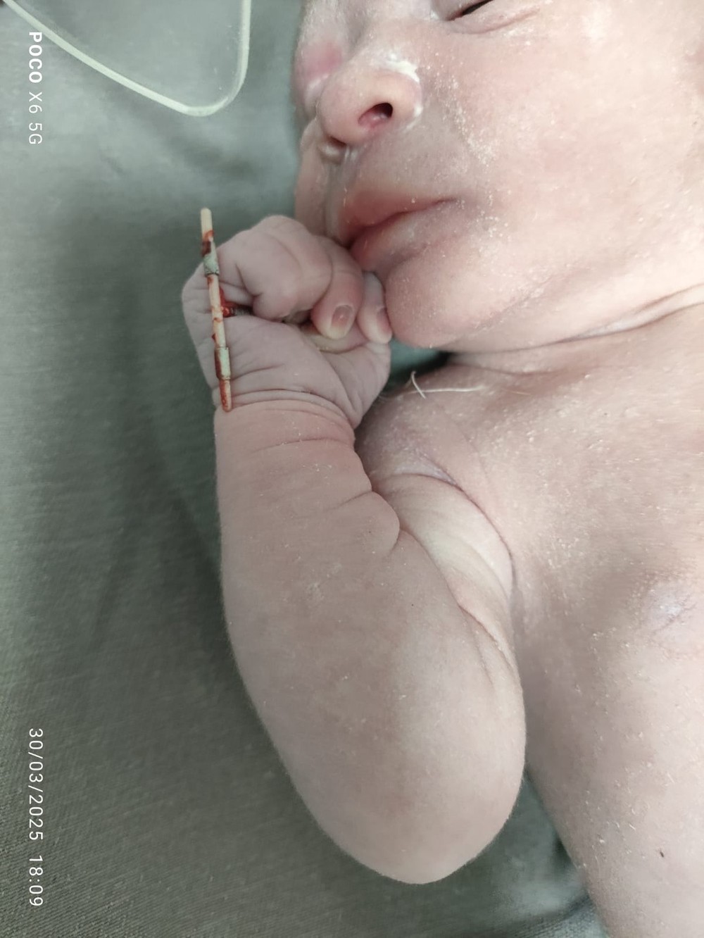 Raríssimo: bebê nasce com DIU, em SP, e mãe faz registro impactante