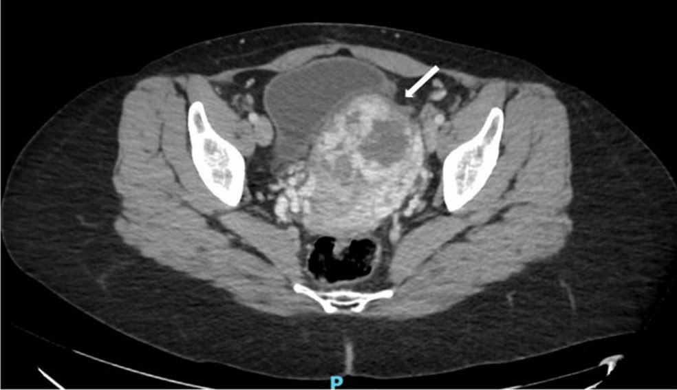 Mulher engravida na cicatriz da cesárea e precisa retirar o útero ...