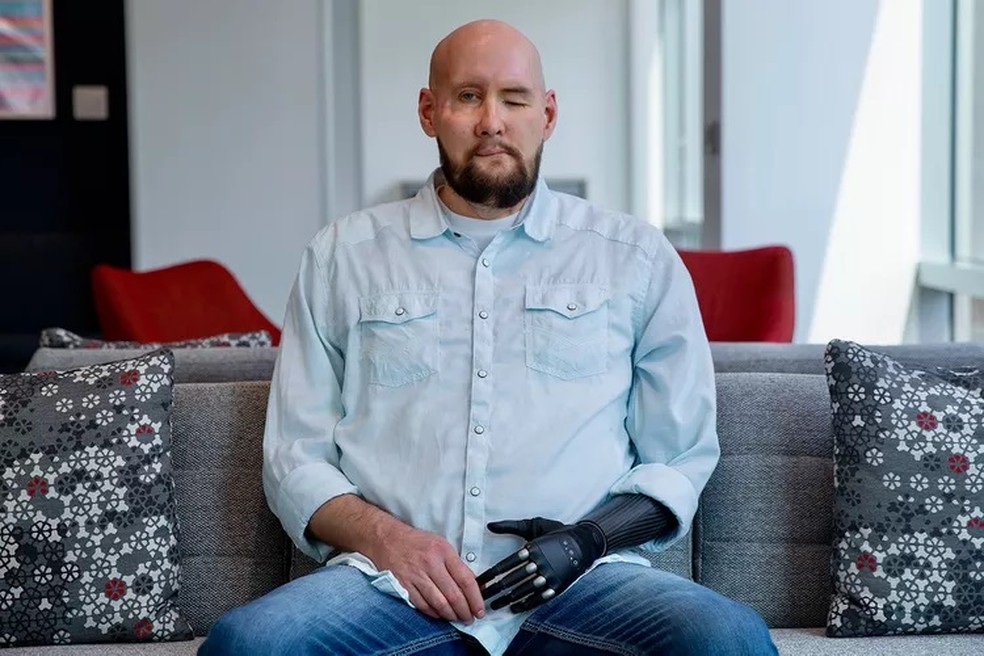 Pai que recebeu transplante inédito de rosto e olhos revela novas fotos