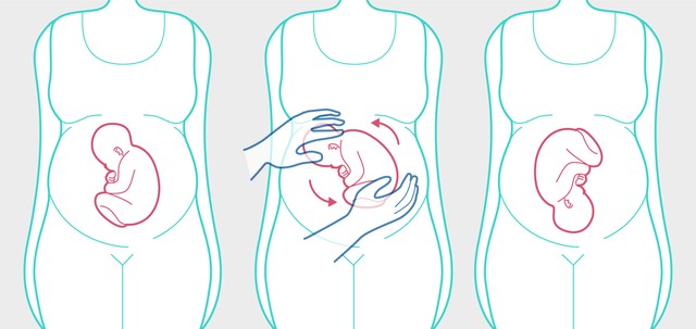 Manobra ajuda a virar bebê dentro da barriga para aumentar as chances ...