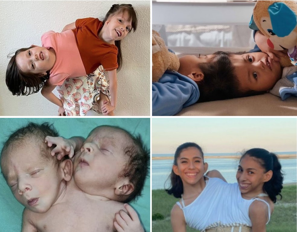 8 histórias impressionantes de gêmeos siameses