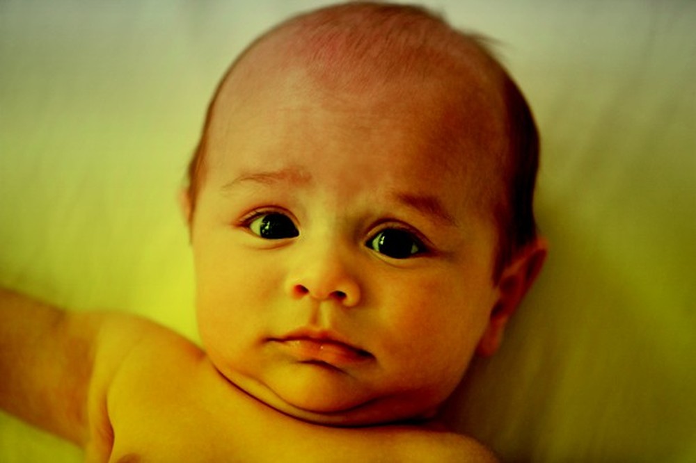 Icterícia neonatal: o que é e como tratar