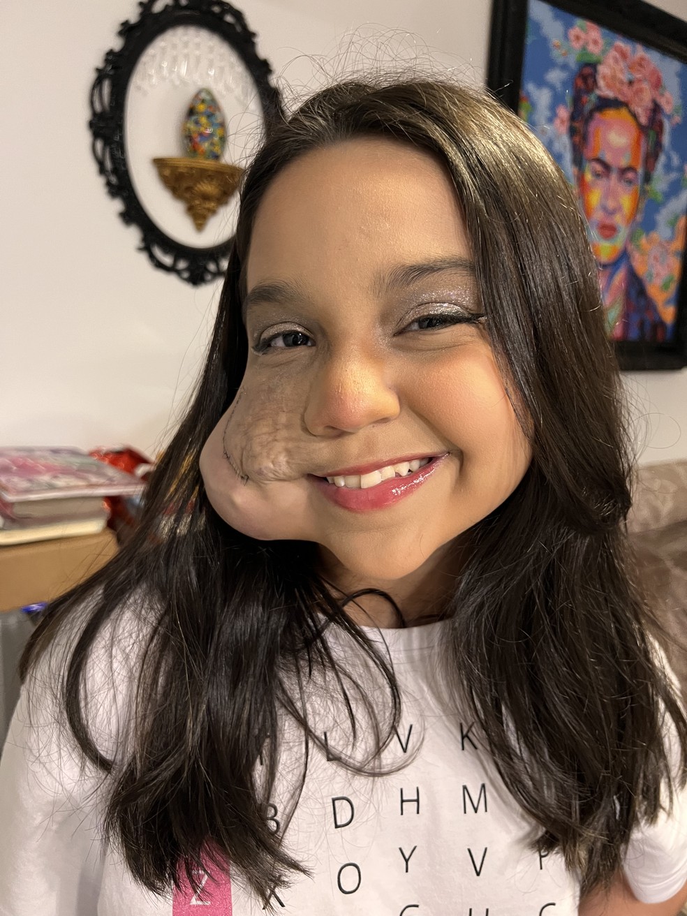 Menina do RJ com hemangioma gigante passa por reconstrução facial. Veja ...