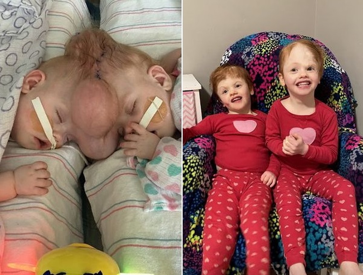 'O céu é o limite para elas', diz mãe de siamesas que receberam 2% de ...